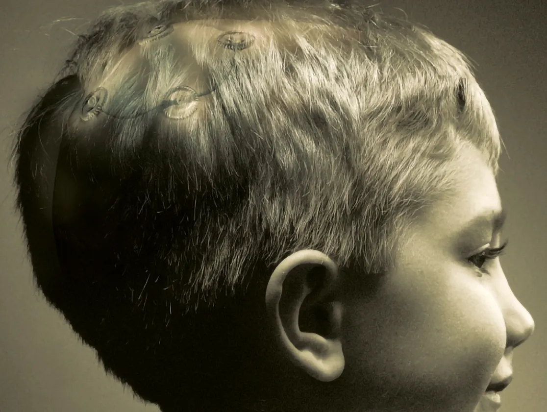 RapidFlap™ LS - Dispositivo de Fijación de Craneotomía Reabsorbible